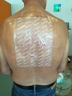 Capsaicin Patch Treatment for Nerve Pain — TampaPainMD