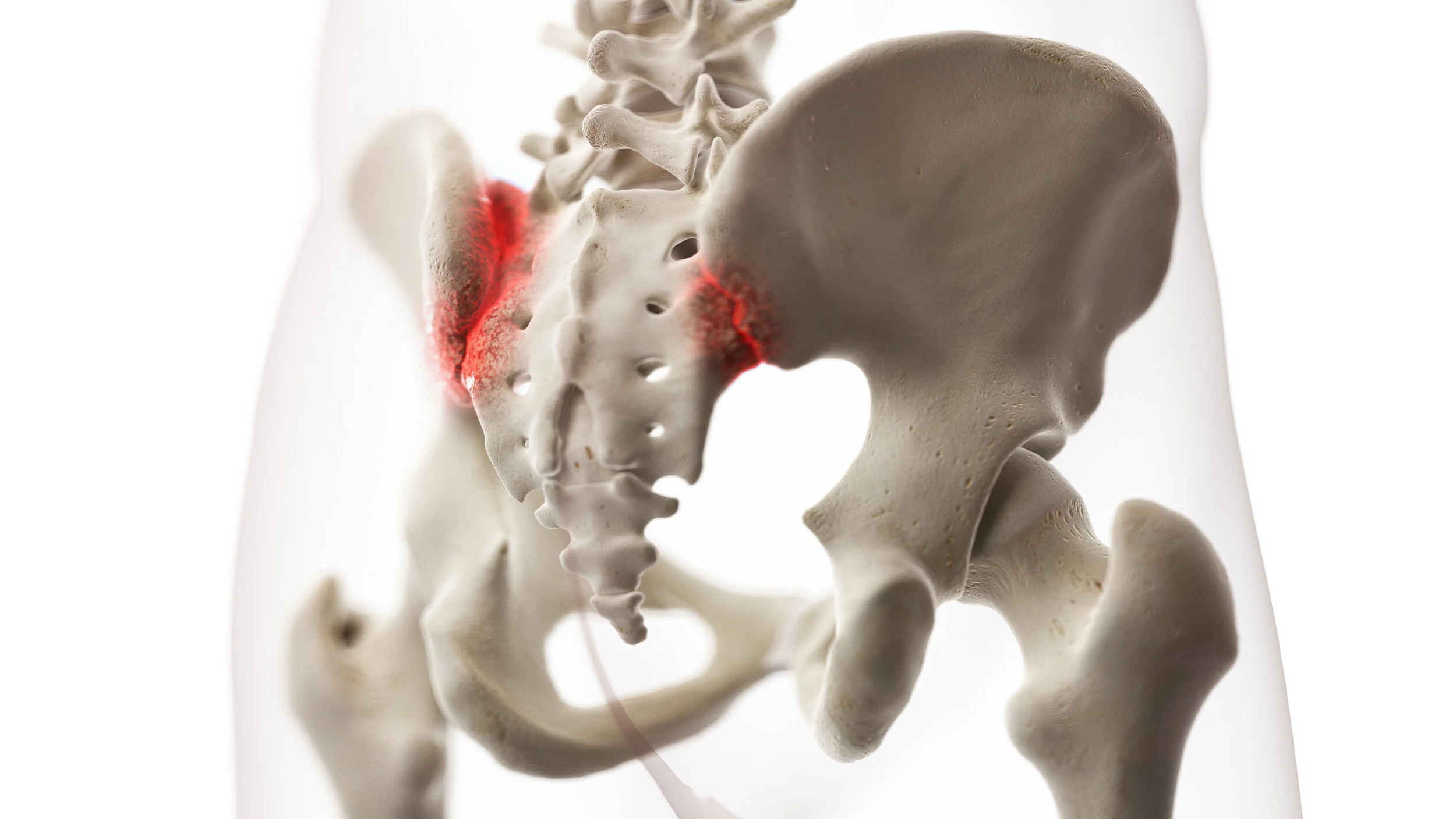 Sacroiliac (SI) Joint Pain — TampaPainMD