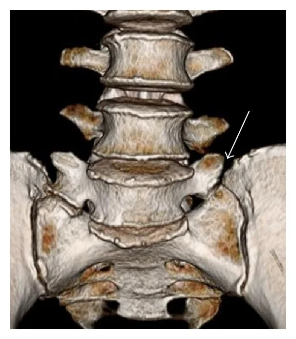 Bertolotti Syndrome — TampaPainMD