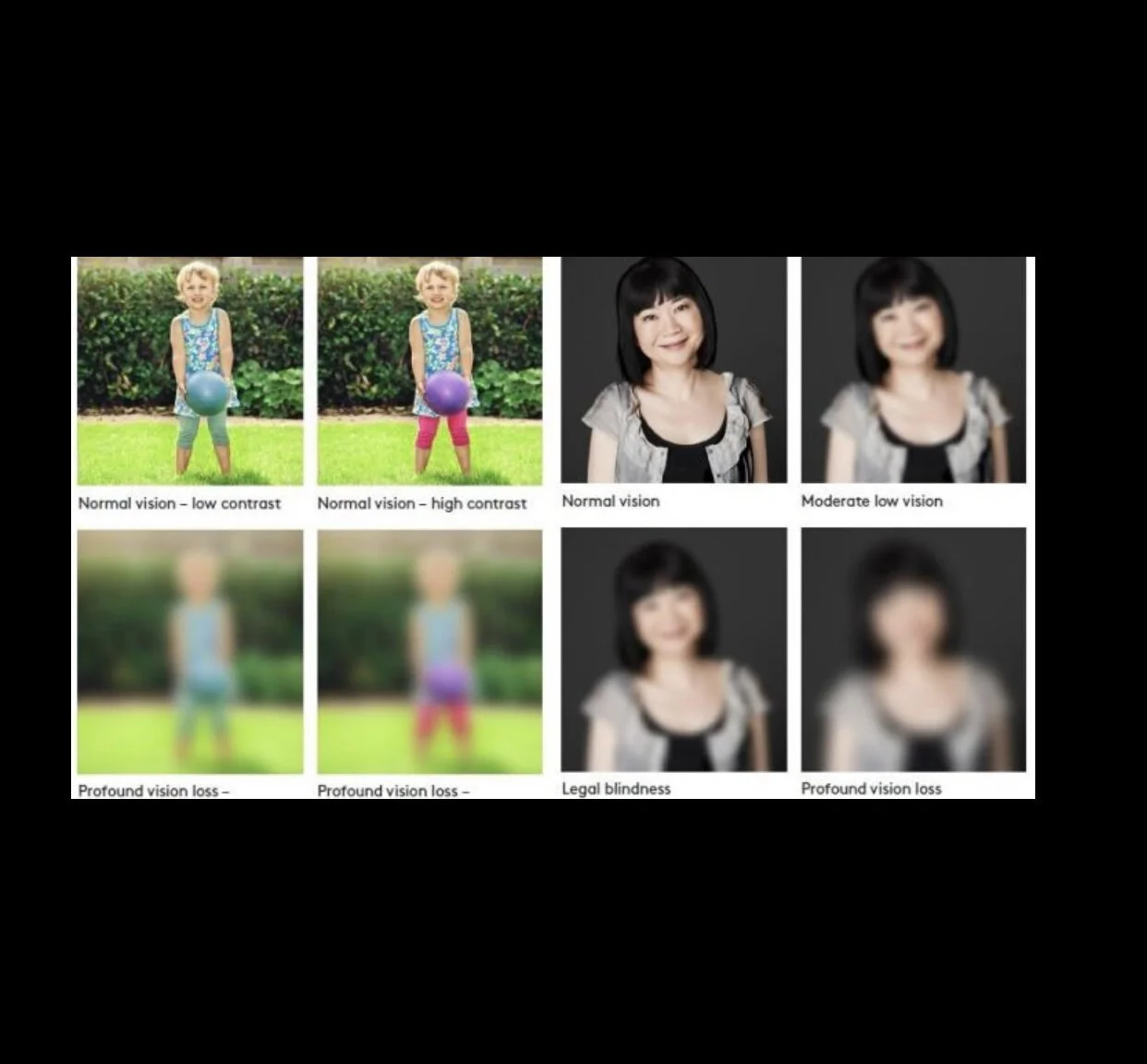 What Is legal blindness?