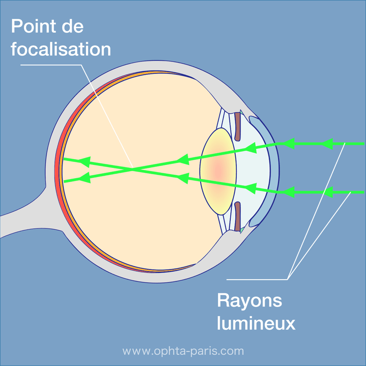 Myopie — OPHTA Paris Clichy