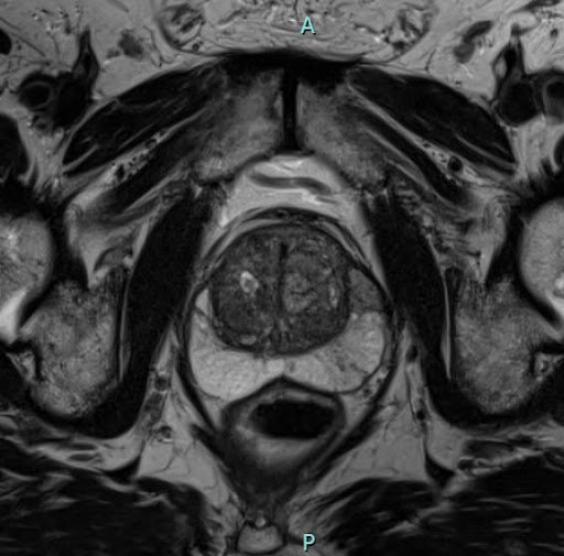 What To Expect During Mri Screening For Prostate Cancer — Radiology