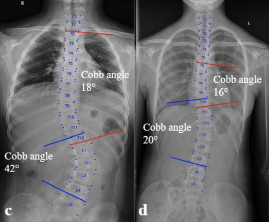 Adolescent Scoliosis — UPG Studio