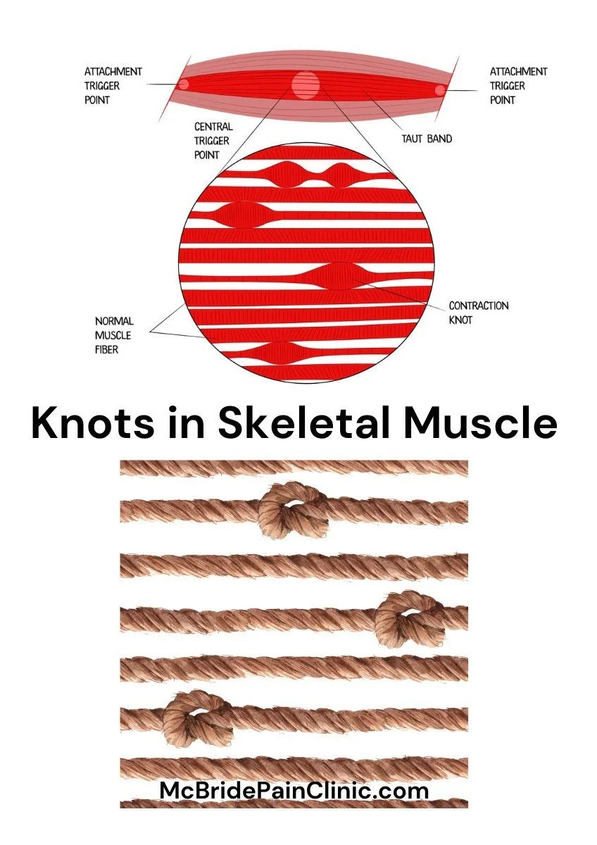 Muscle Knots - Trigger Points — McBride Pain Clinic