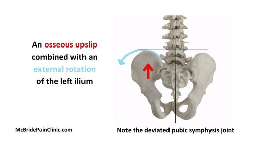 Pelvis Rotations and Upslips — McBride Pain Clinic