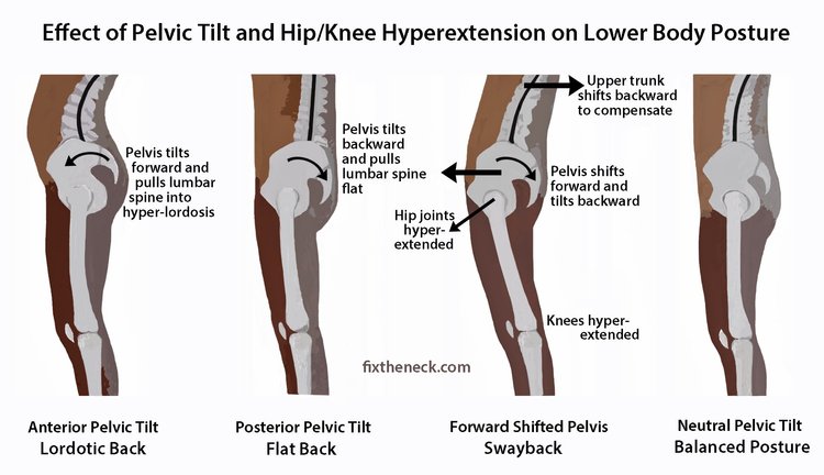Pelvis Rotations and Upslips — McBride Pain Clinic