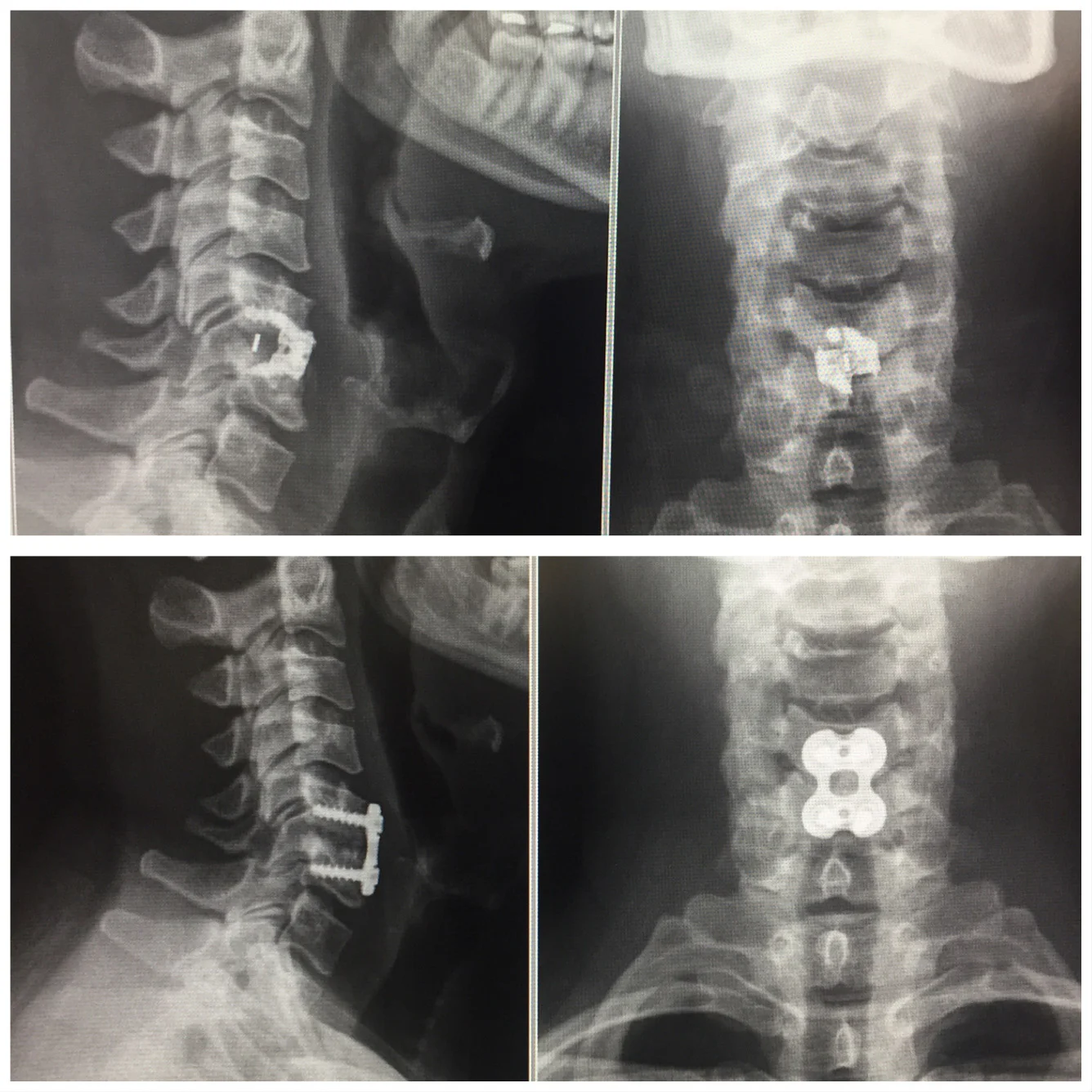 Successful Revision Spine Surgery | Minimally Invasive Denver Spine ...