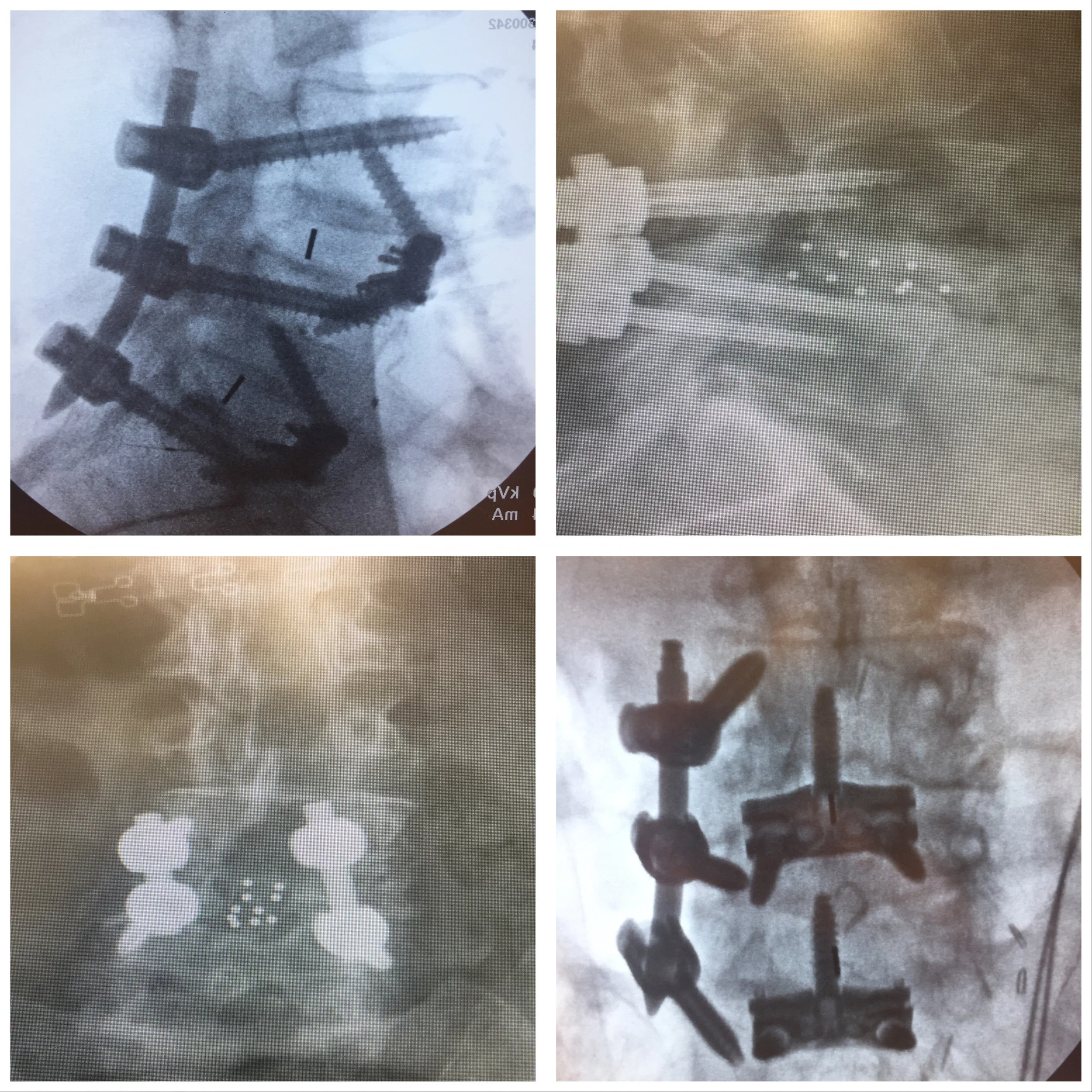 Successful Revision Spine Surgery | Minimally Invasive Denver Spine ...