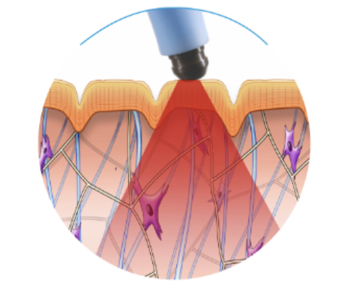 BTL Exilis Skin Tightening — Dr. Hong Med Spa - Newton, MA