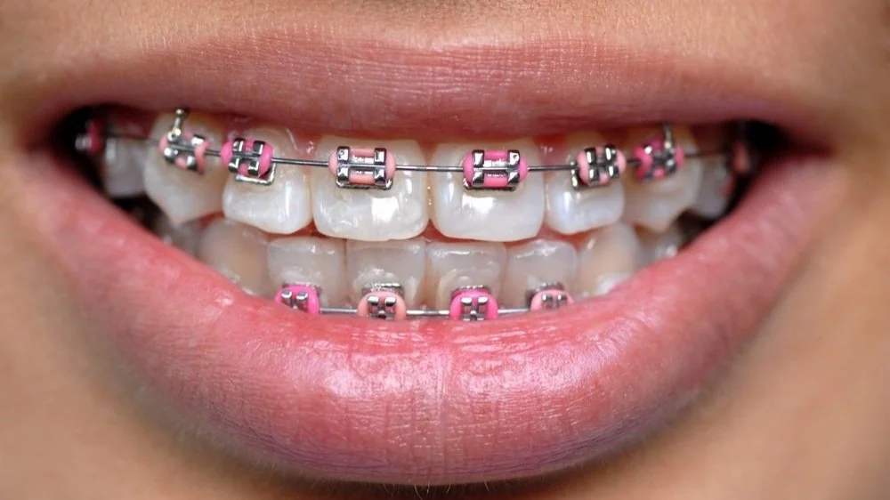 Metal Braces in Silverdale, Poulsbo & Port Orchard — Johnsonlink ...
