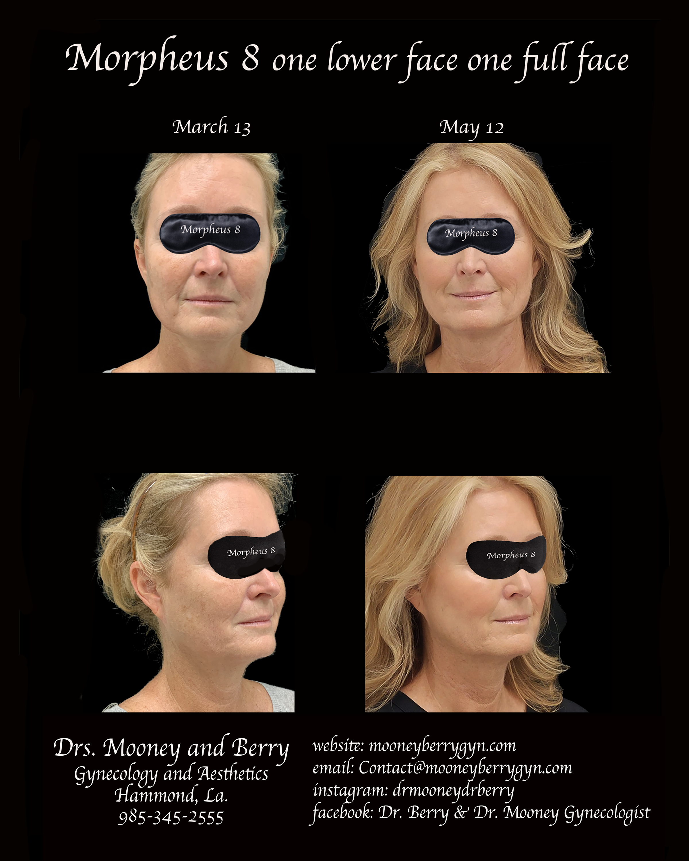 Before and After -Morpheus 8 Face — Drs. Mooney & Berry