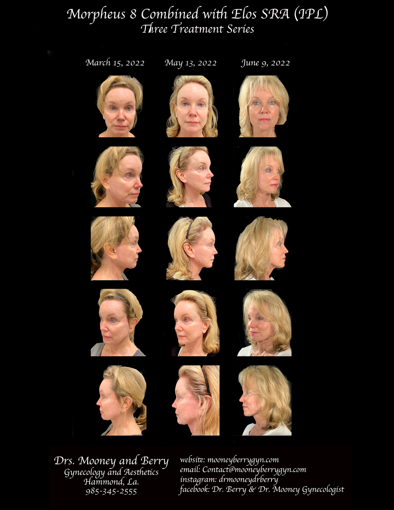 Before and After - Morpheus 8 Body — Drs. Mooney & Berry