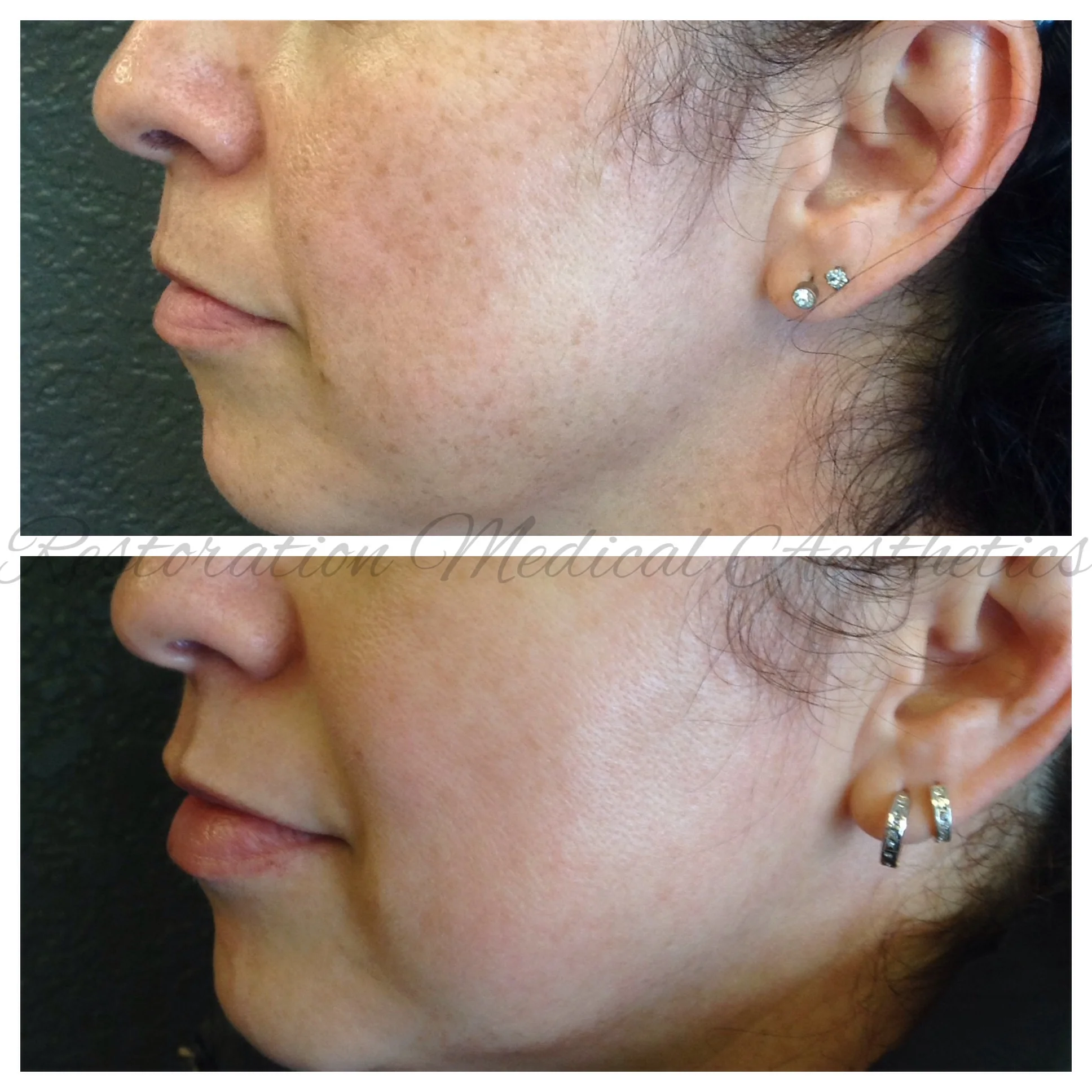 Before & Afters — Restoration Medical Aesthetics