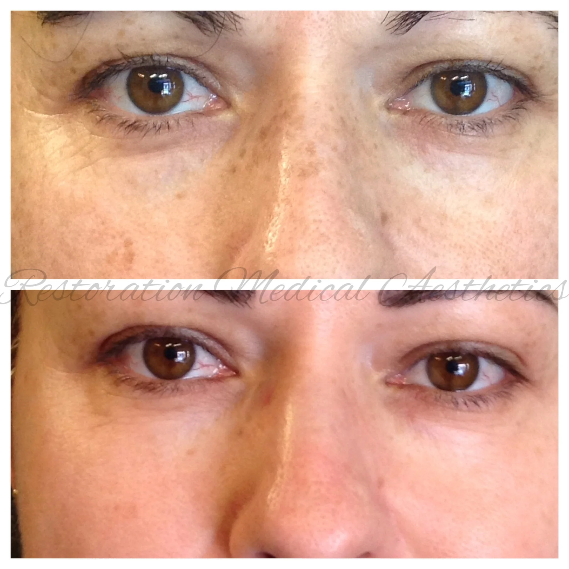 Photo Rejuvenation (Photofacial) — Restoration Medical Aesthetics