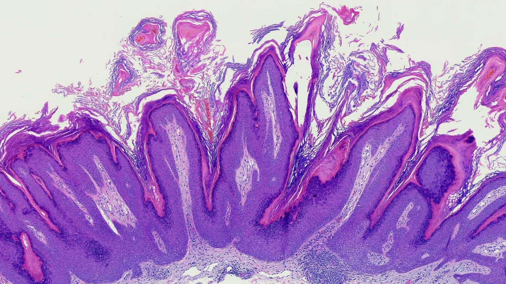 Verruca Plana Histopathology