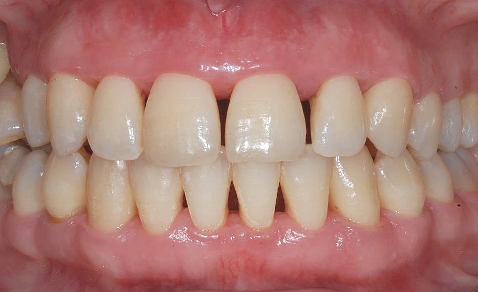 Traitements parodontaux — Dr Frédéric Rouche