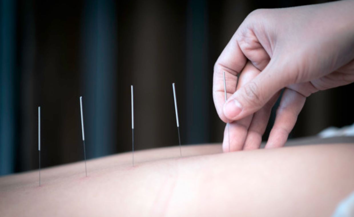 Acupuncture — Southall Chiropractic