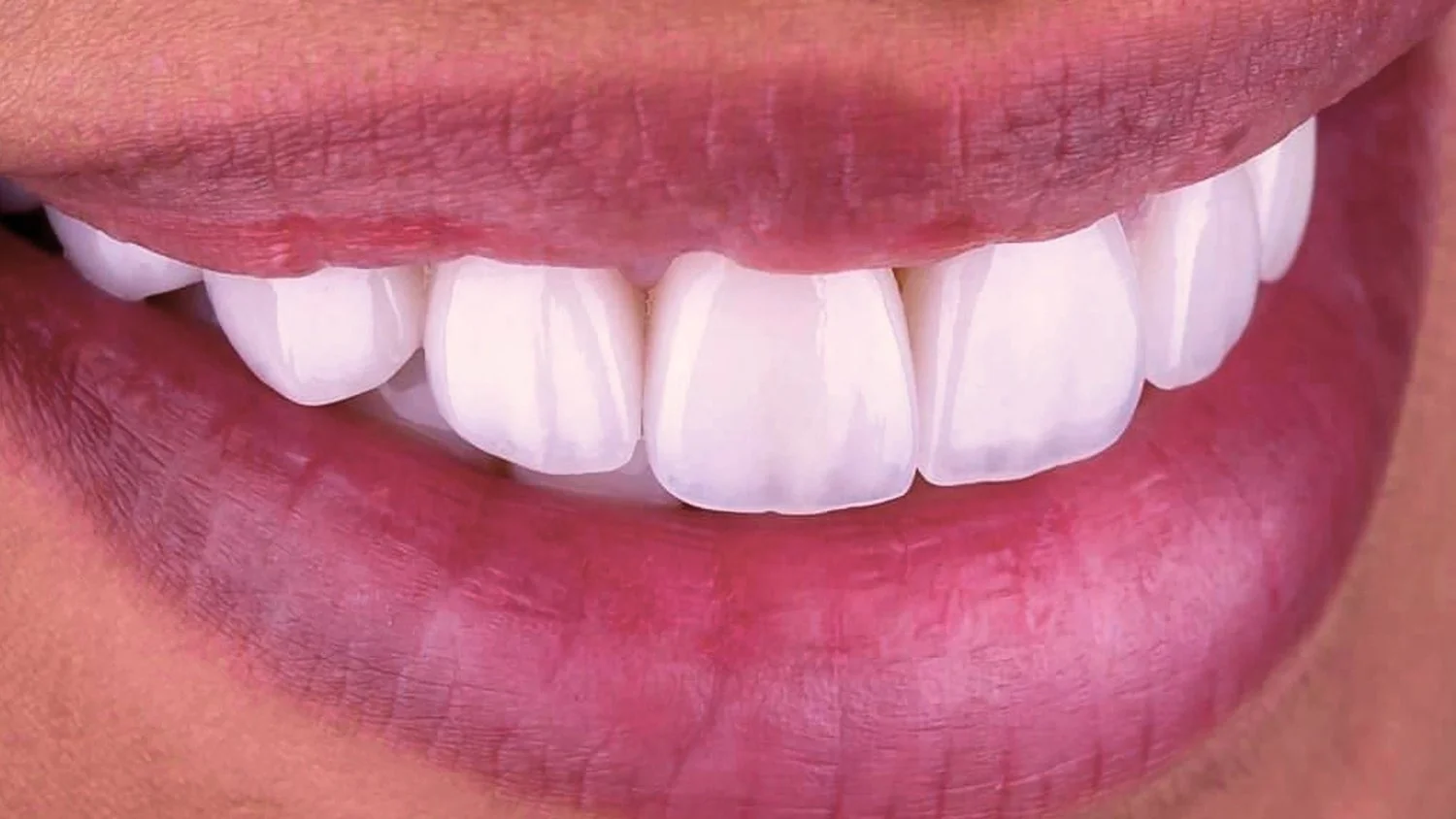 THE SMILE MAKEOVER; COMPOSITE VENEERS VS. PORCELAIN VENEERS — S3 DENTAL ...