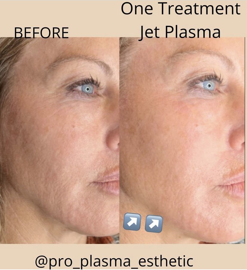 Plasma Pen in Golden, CO | Radiant Skin RN