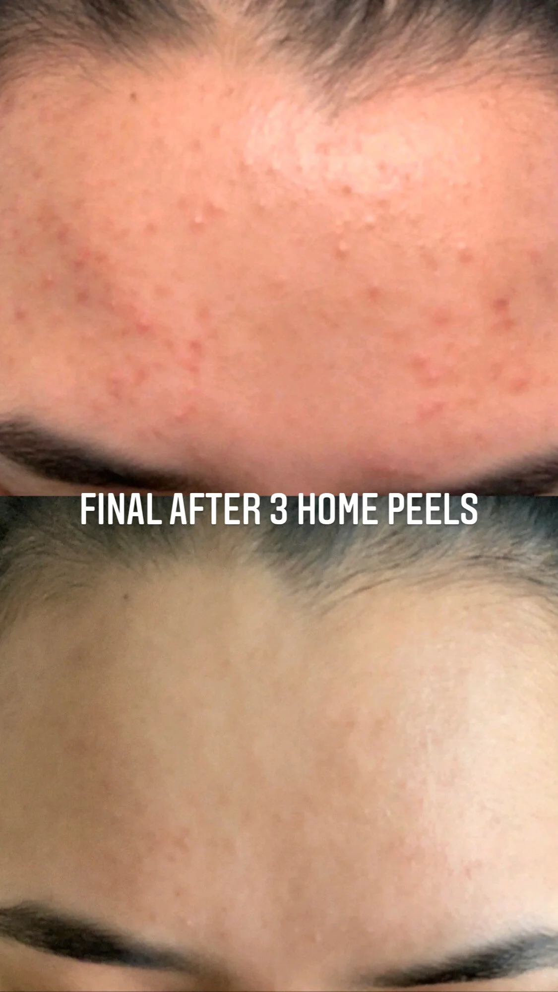 The Peel Connection® offers At Home Chemical Peels