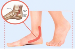 Tibialis Posterior Tendinopathy Recognition and Treatment — Fit For Life