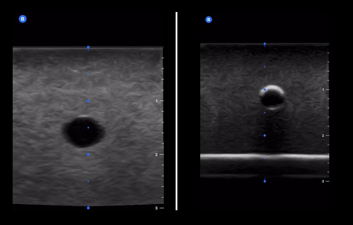 DIY Ultrasound Phantom Pad — Mark Sescon, RN, BSN