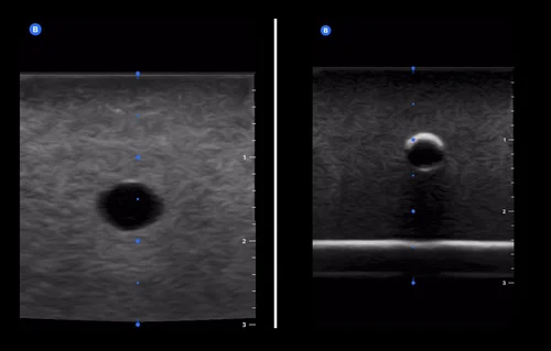 DIY Ultrasound Phantom Pad — Mark Sescon, RN, BSN