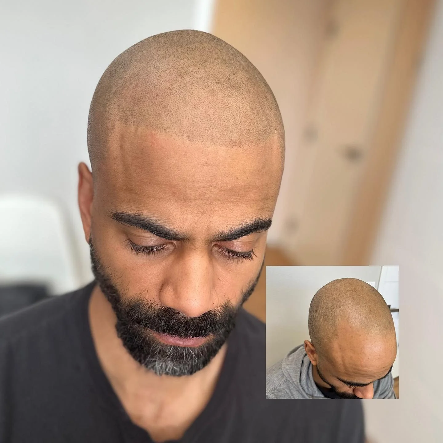 Scalp Therapy Micro Scalp Micropigmentation/Hair Loss Solution