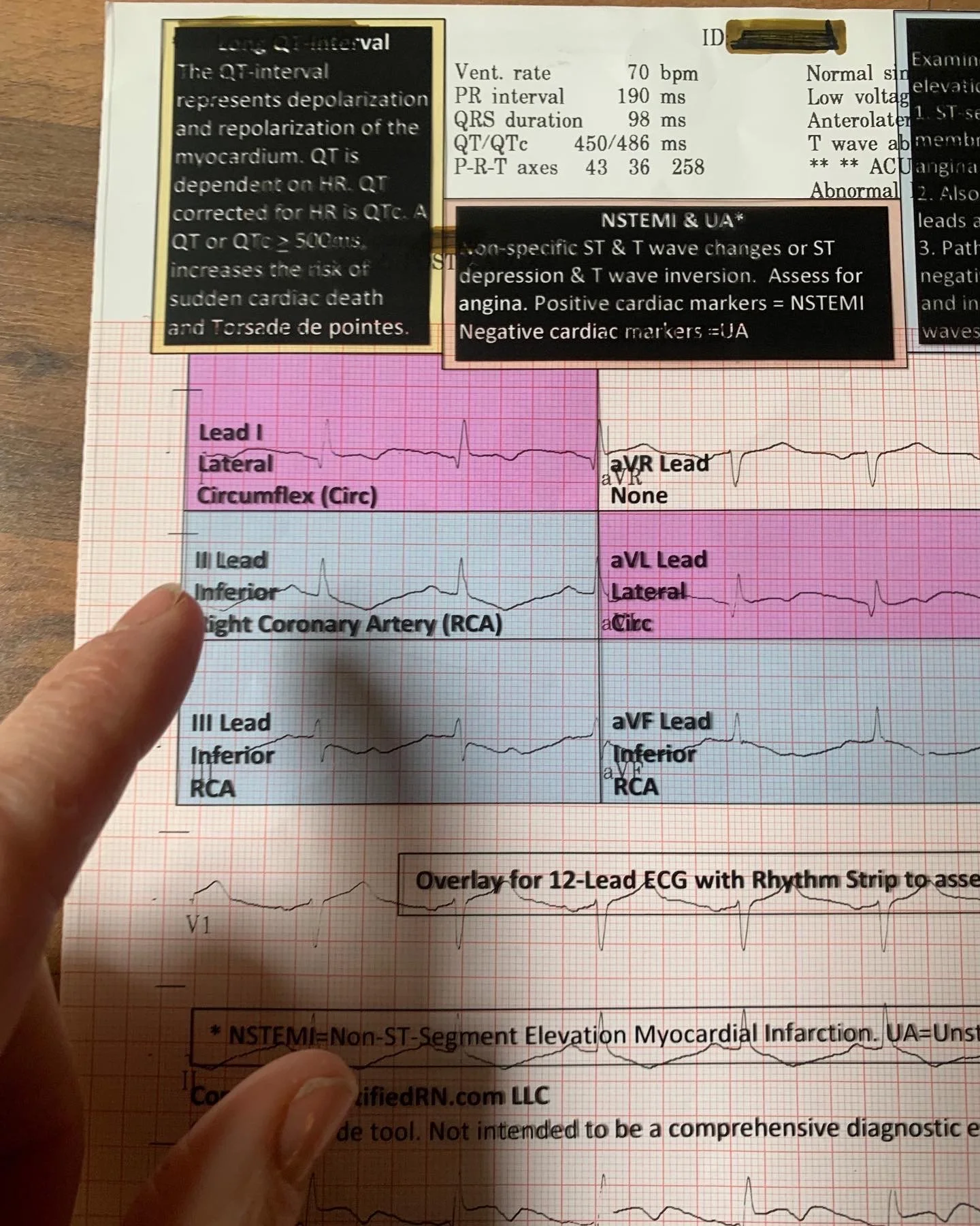 12-lead EKG ECG Overlay To Detect STEMI/NSTEMI —, 03/08/2024