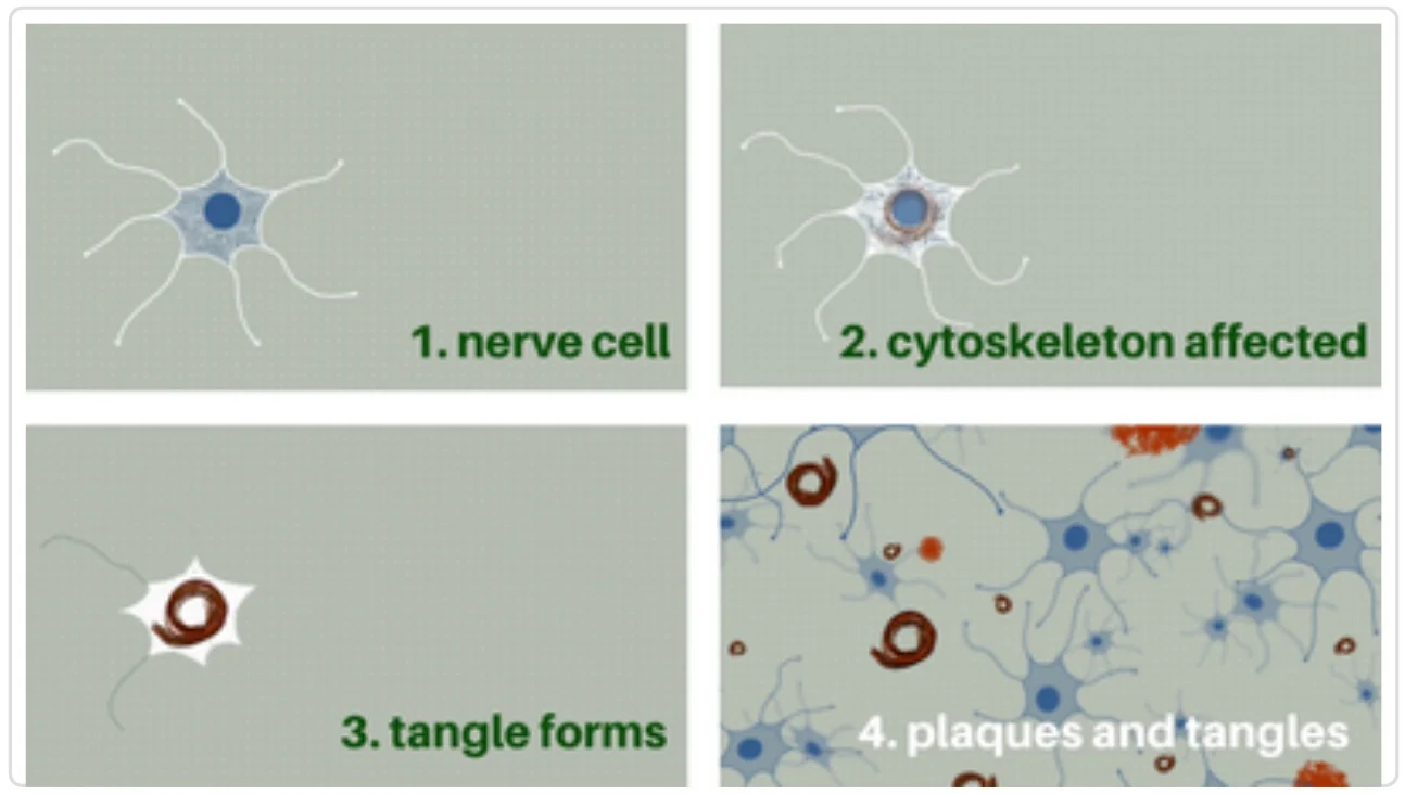 An Introduction to Alzheimer's Disease. — Andréas Astier