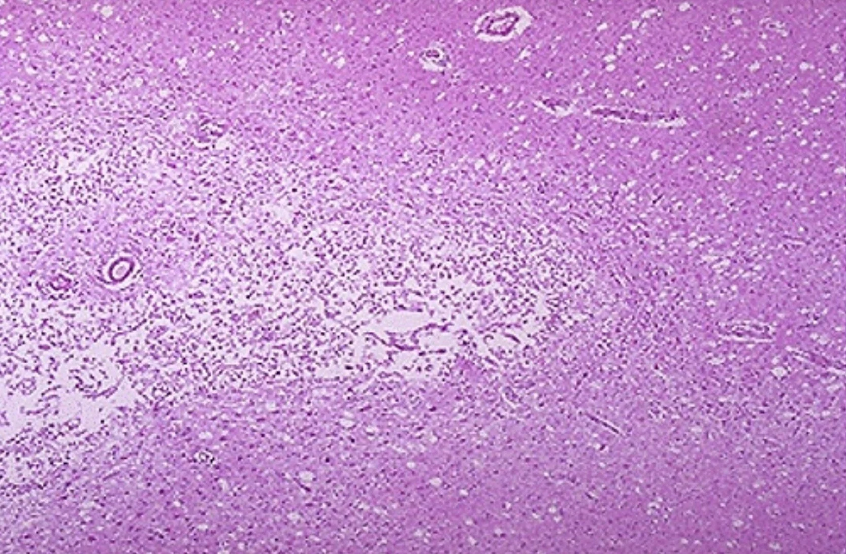 Caseous Necrosis Histology