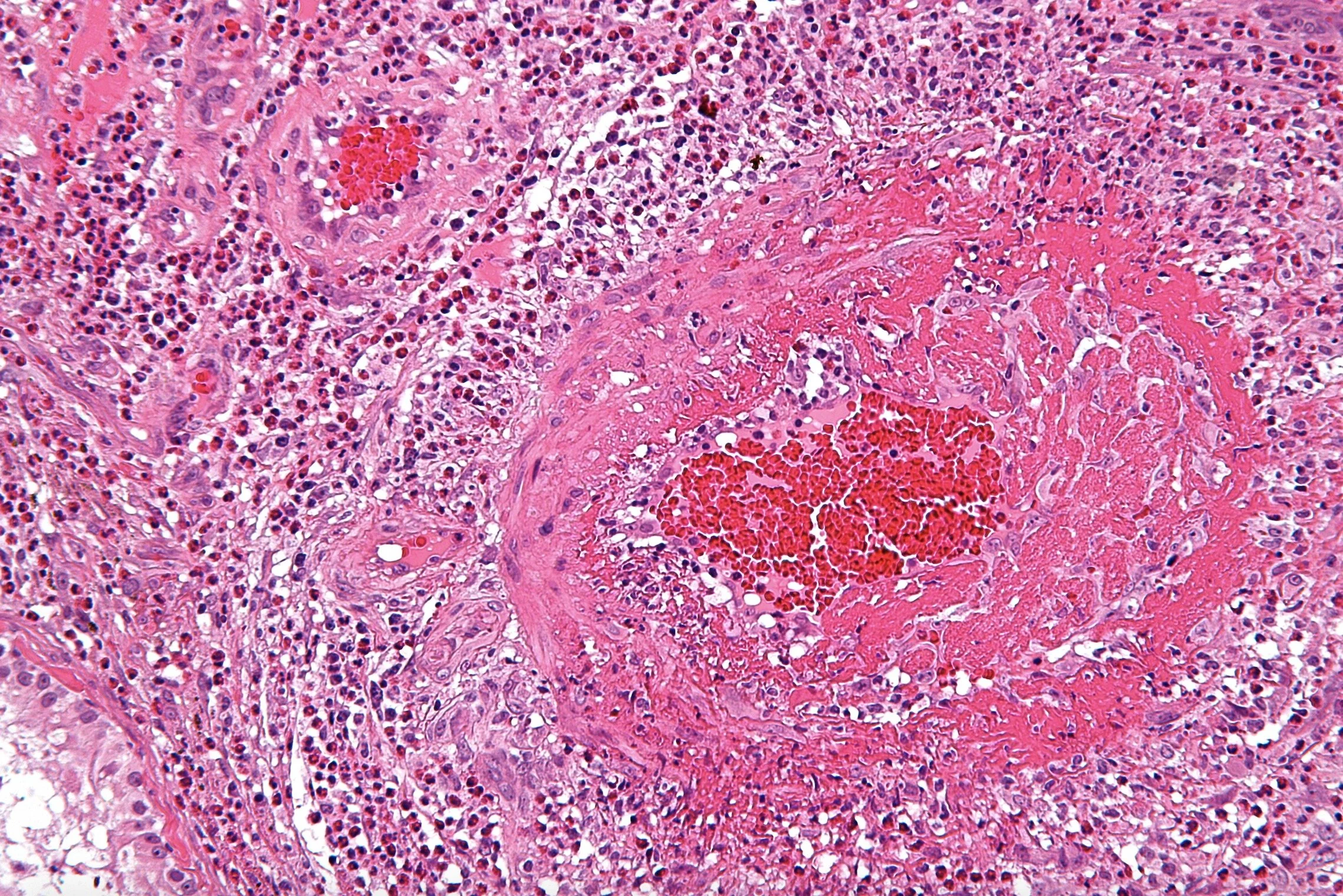 Caseous Necrosis Histology