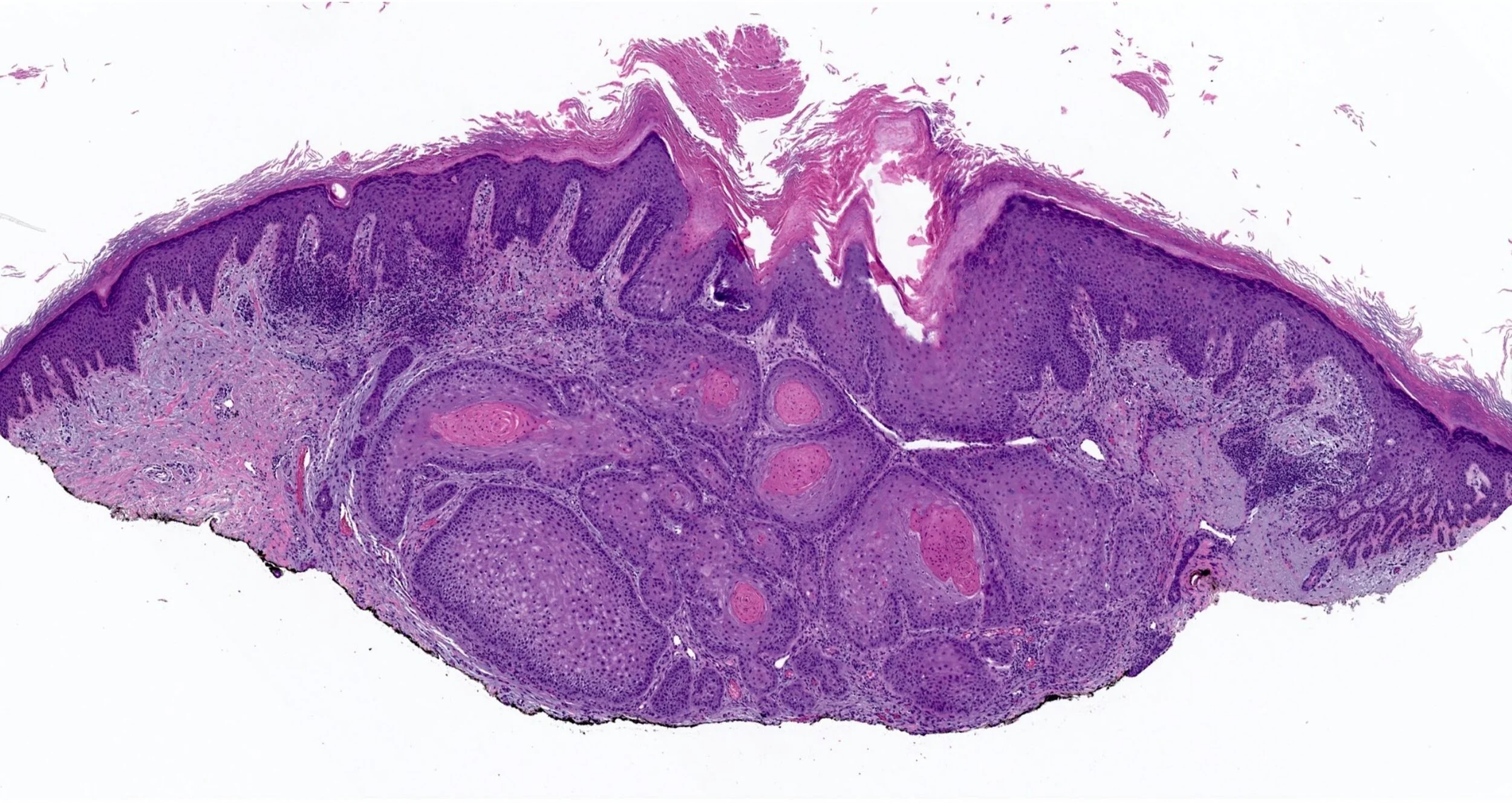 Main Type of Skin Cancer — Their Differences, Histology and Prevention ...