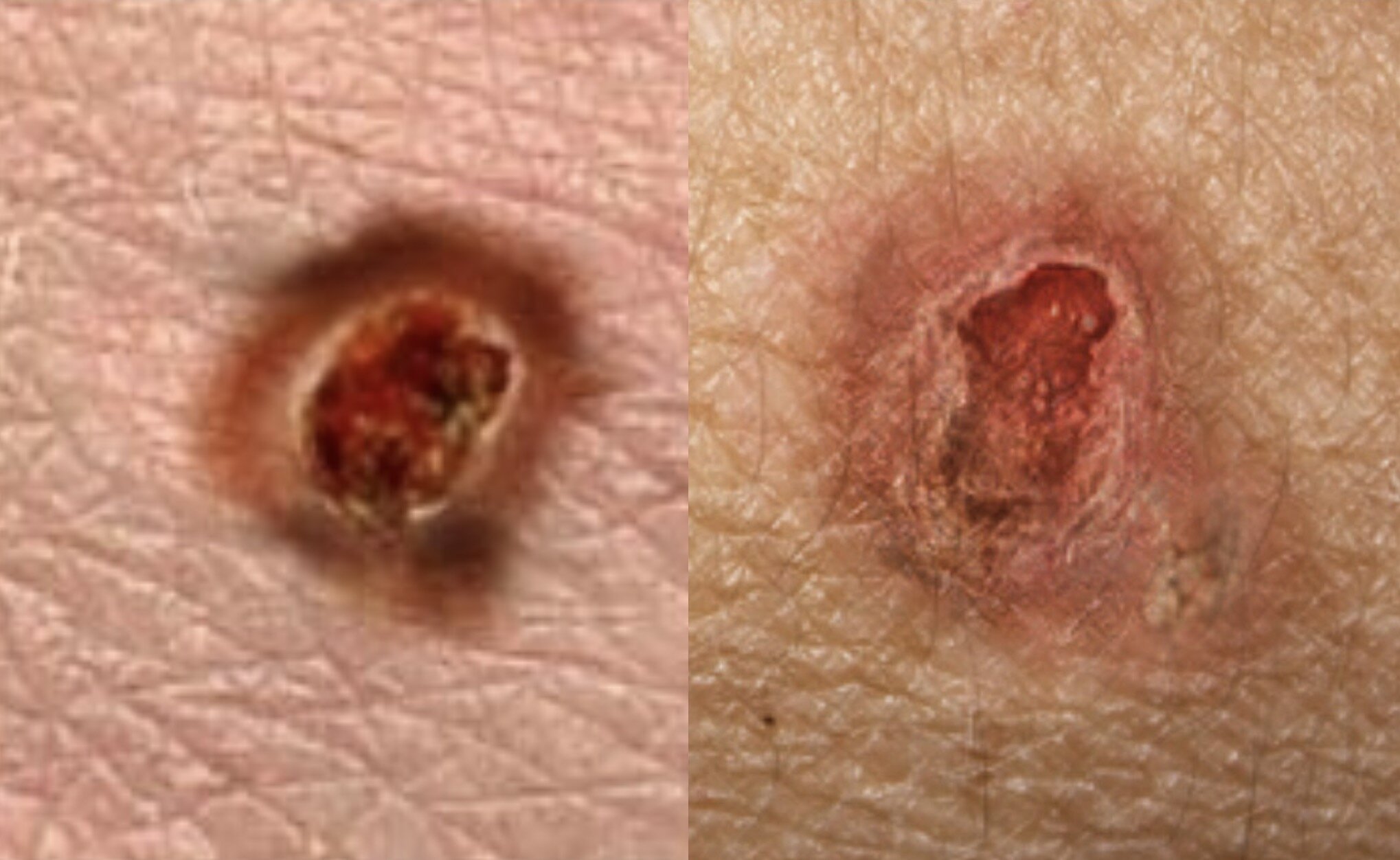 Main Type of Skin Cancer — Their Differences, Histology and Prevention ...