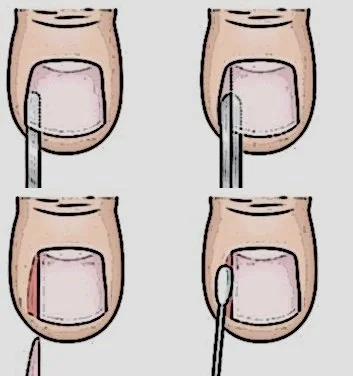 Skin & Minor Surgery — Freemans Bay Medical Centre