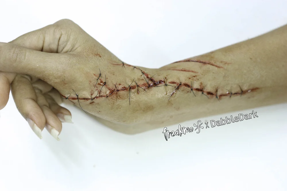 Stitches In Arm How Long