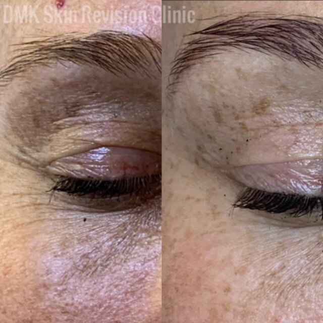 Before and Afters — DMK Skin Revision Clinic
