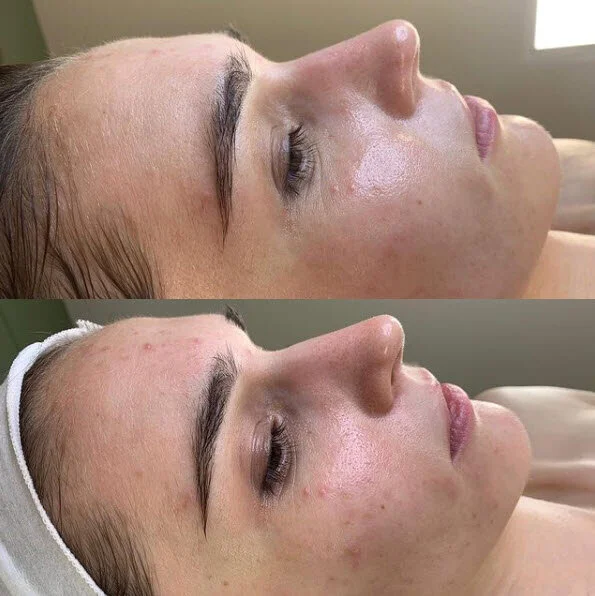 Before and Afters — DMK Skin Revision Clinic