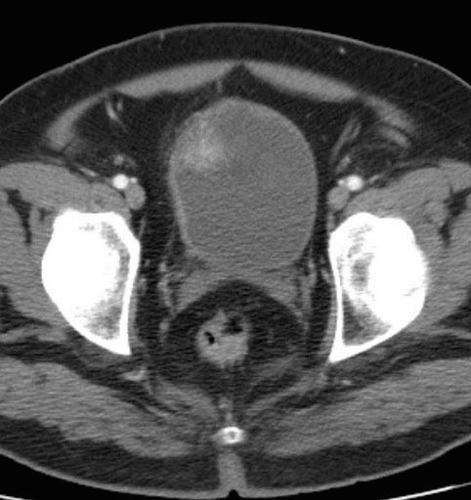 Scanner Vessie Femme Cancer De La Vessie Et Voies Urinaires CDJF