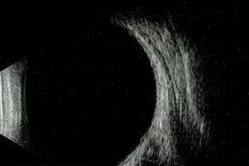 Retina Probes — OPI LLC