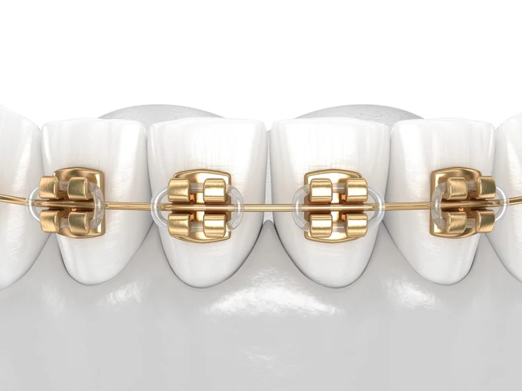 Types of Braces and Appliances — Marysville Orthodontics | Braces ...