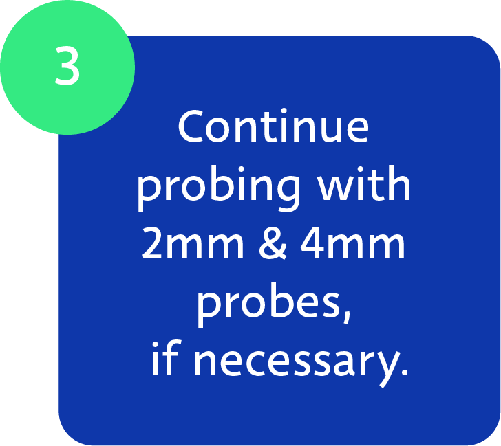 Maskin Meibomian Gland Probing: For Physicians — MGDinnovations