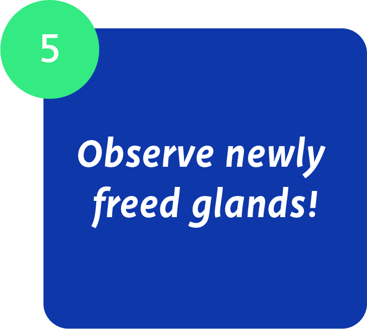 Maskin Meibomian Gland Probing: For Physicians — MGDinnovations