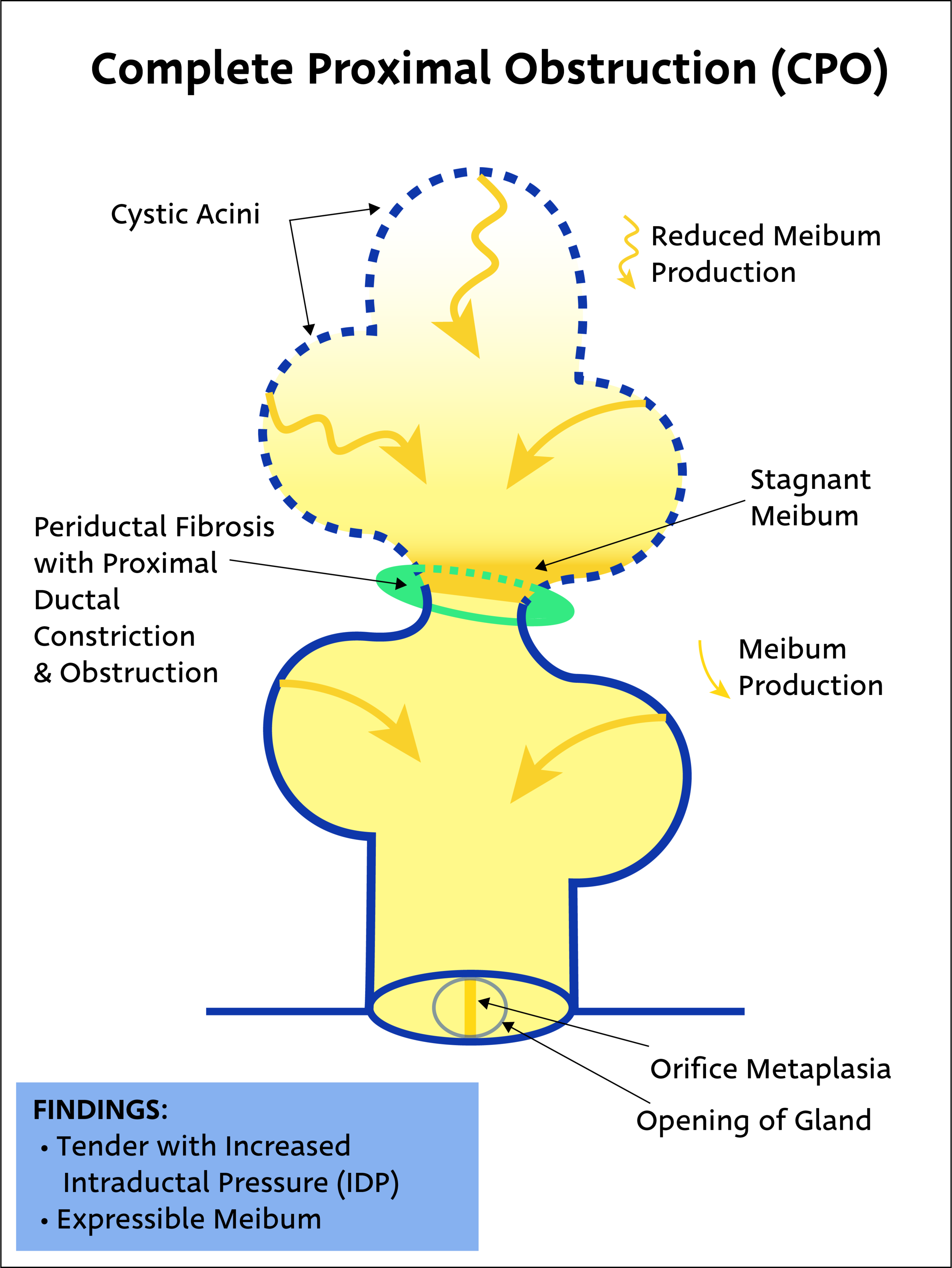 Maskin Meibomian Gland Probing: For Physicians — MGDinnovations