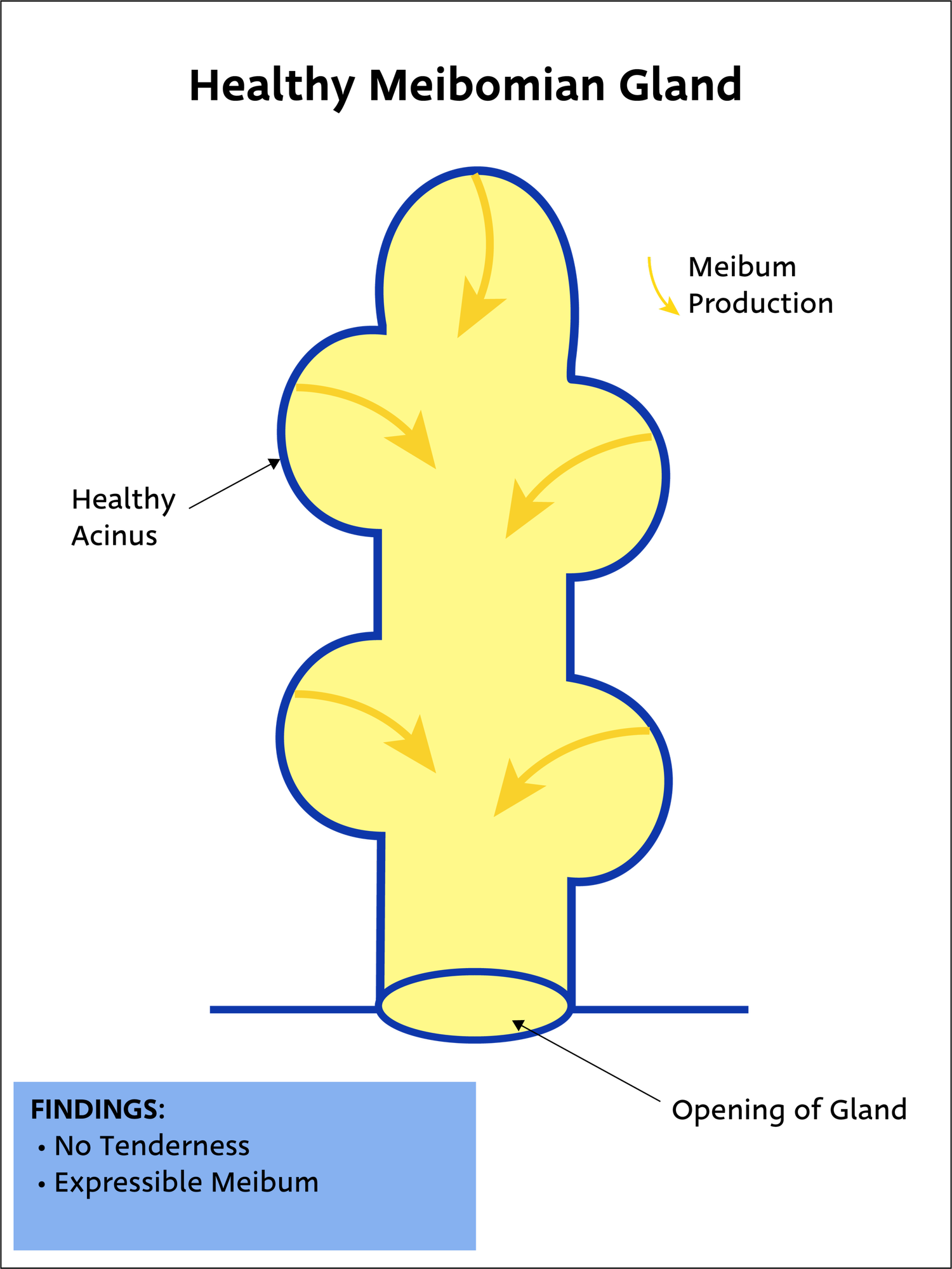 Maskin Meibomian Gland Probing: For Physicians — MGDinnovations