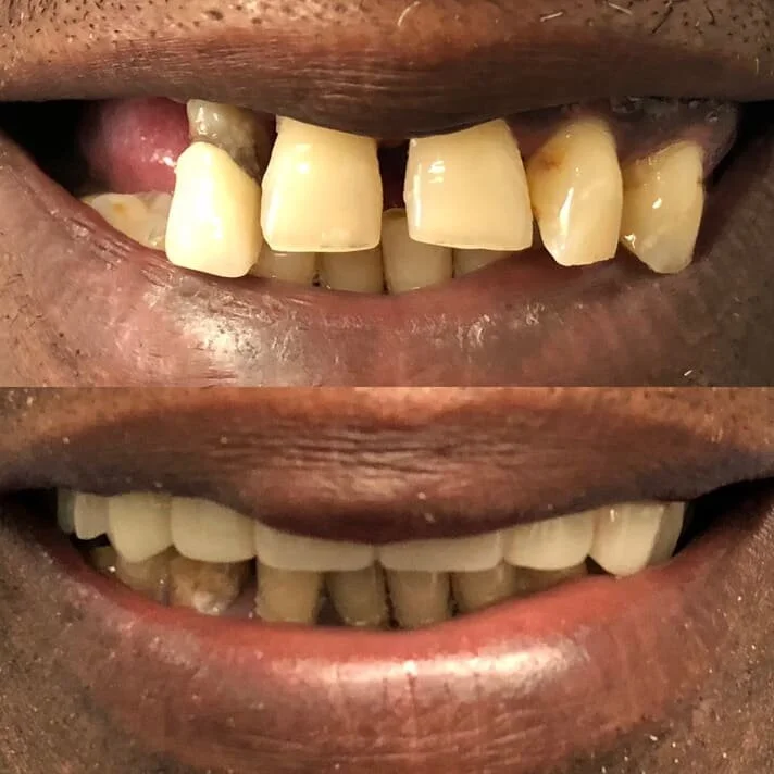 Crooked Teeth Before And After