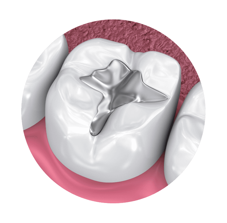 Tin Amalgam Mercury