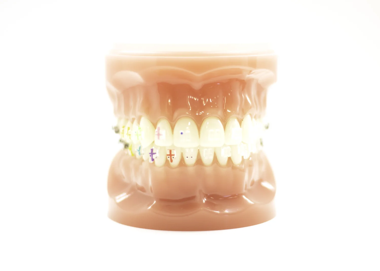Ceramic Braces In Singapore | Align Braces Clinic