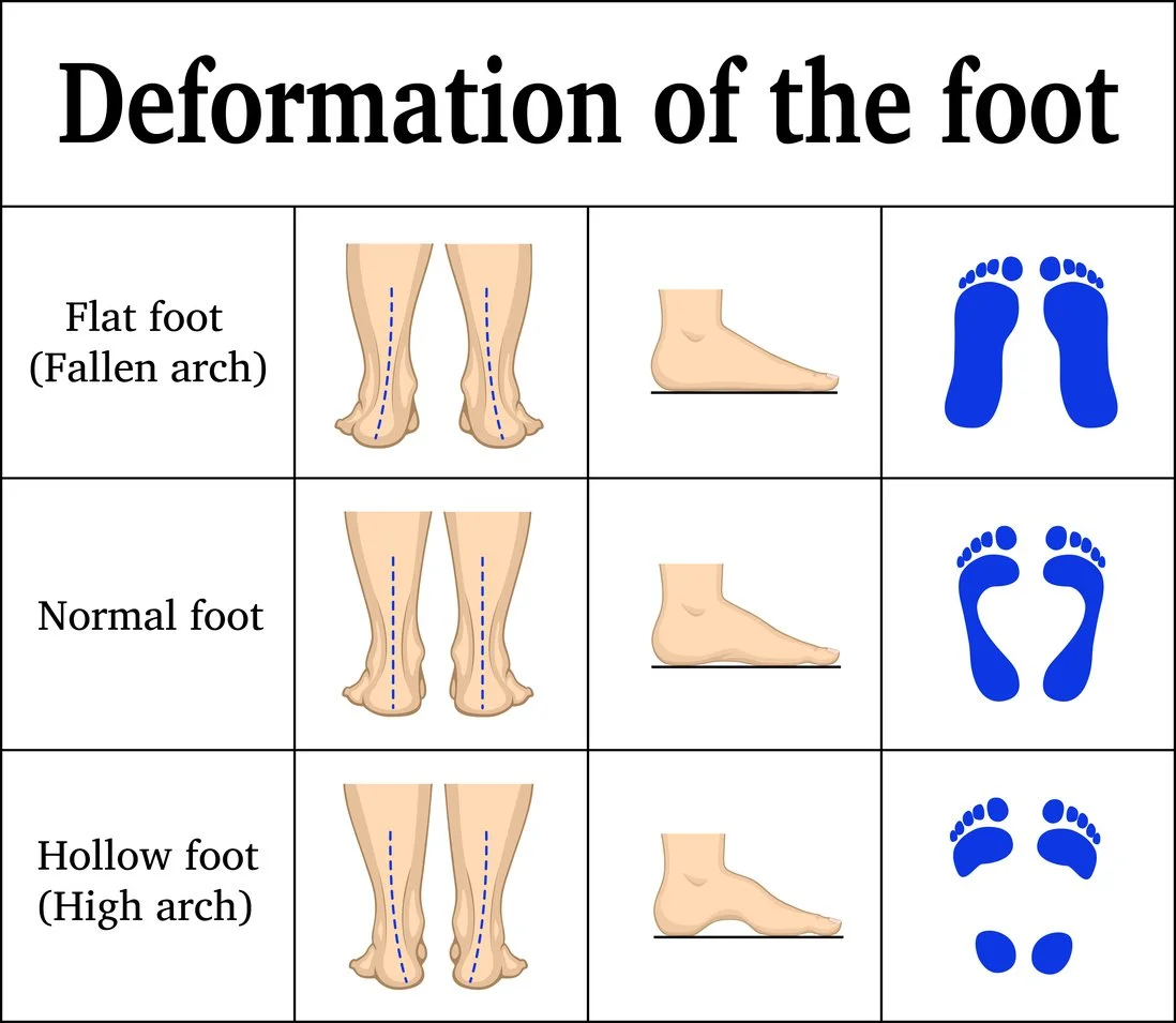 Is Having Flat Feet Bad PHYSIO AT YOUR HOME Is Having Flat Feet Bad PHYSIO AT YOUR HOME