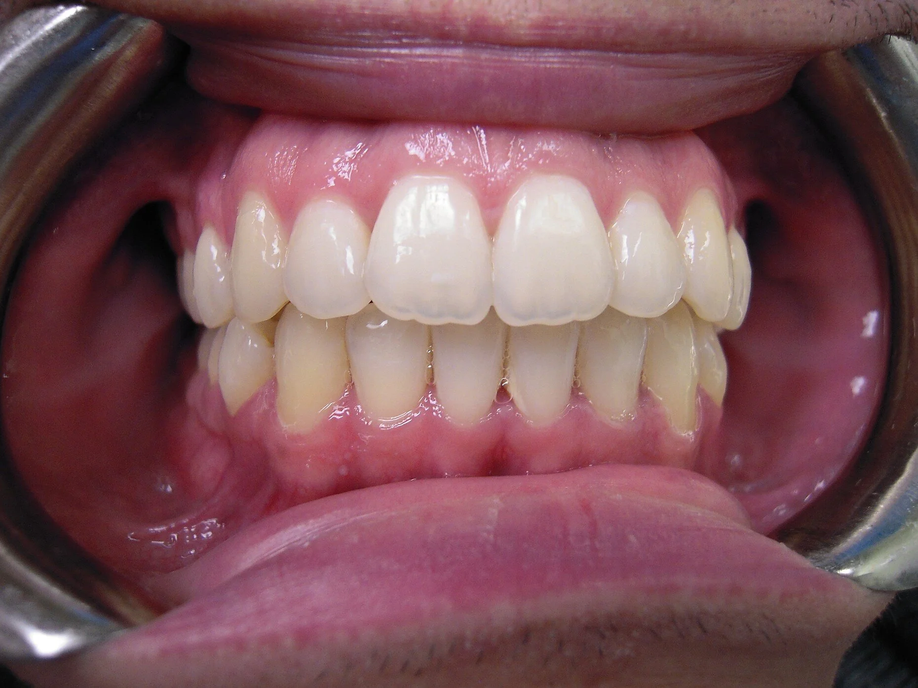 Case Gallery — AACA | The American Academy of Clear Aligners